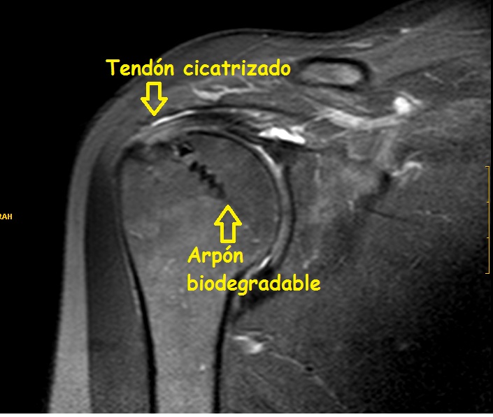 Patologías de hombro: Ruptura de tendon supraespinoso