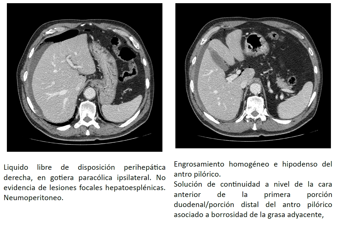 El Blog de Isa y Juan: Neumoperitoneo