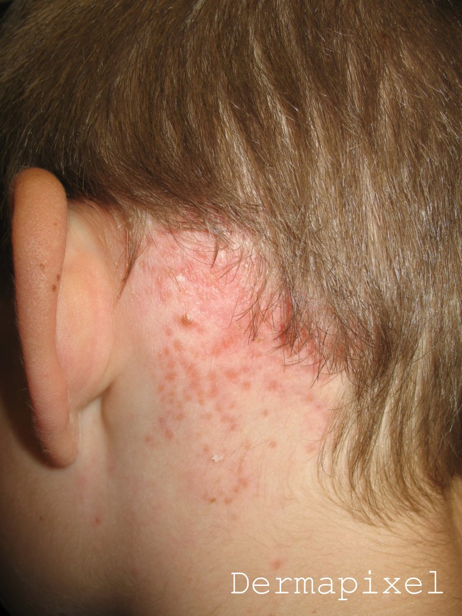 Cara De Cabeza De Hongo