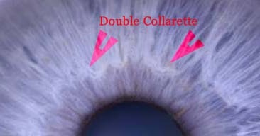 Modern & Multidimensional Iridology: Double Collarette at Frontal ...