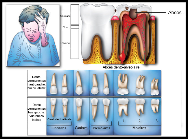Voici des remèdes maison pour soulager rapidement le mal de dents ...