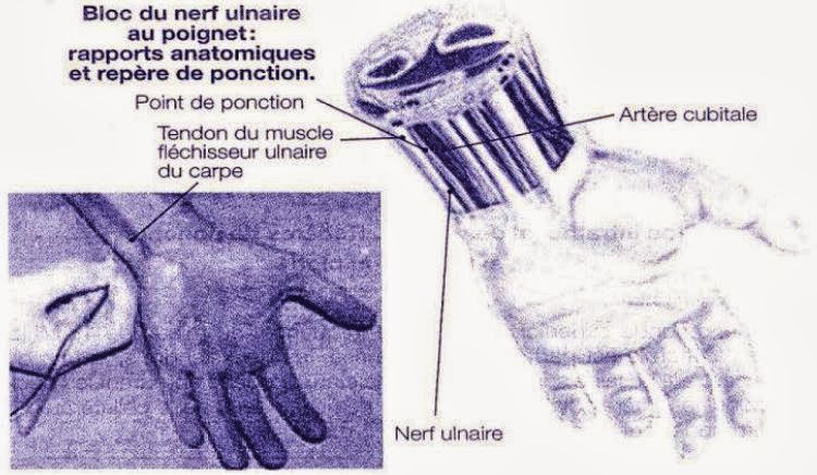 BLOC DU NERF ULNAIRE (CUBITAL) ~ Médecine en français