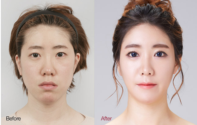 ID Hospital Korea: [ID Hospital - Best plastic surgery in Korea] ID's ...