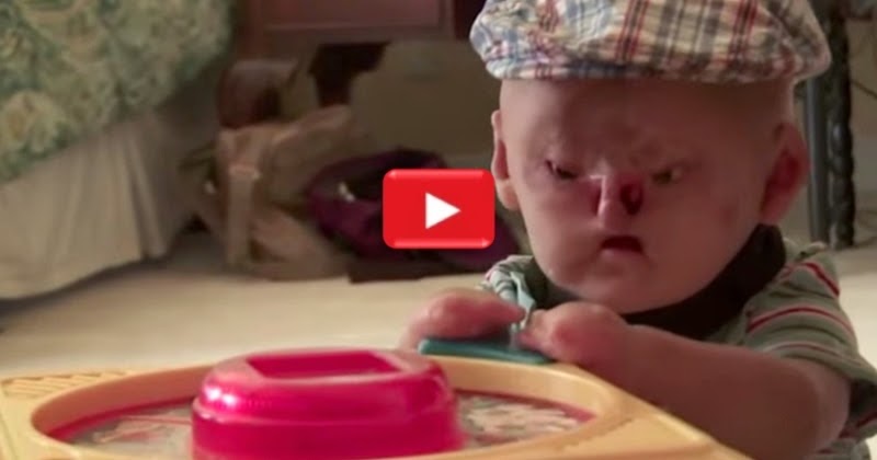 SAVING BABY ADAM - Born severely deformed, but got a second chance from ...