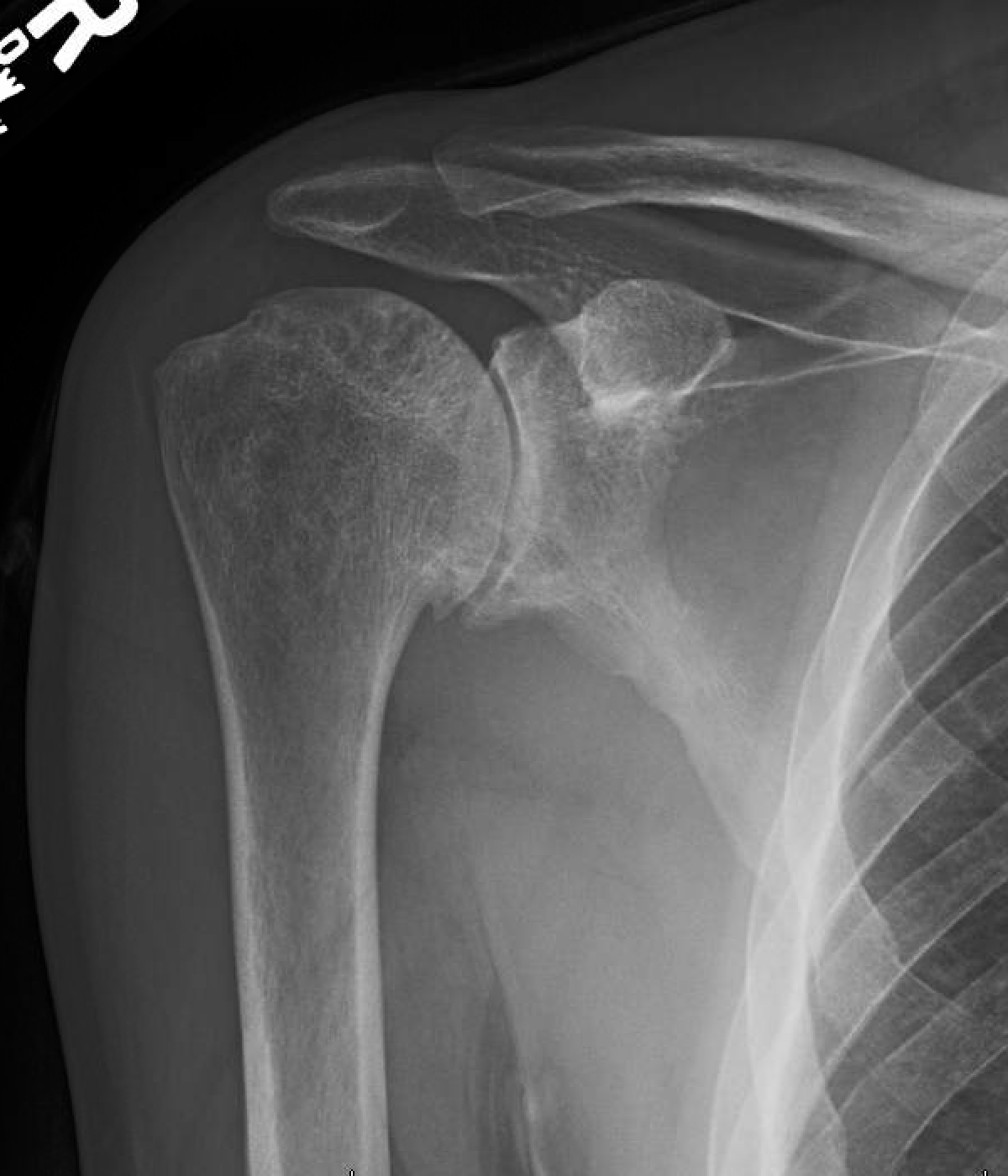 Shoulder and Elbow Surgery: Short stems in anatomic total shoulder ...
