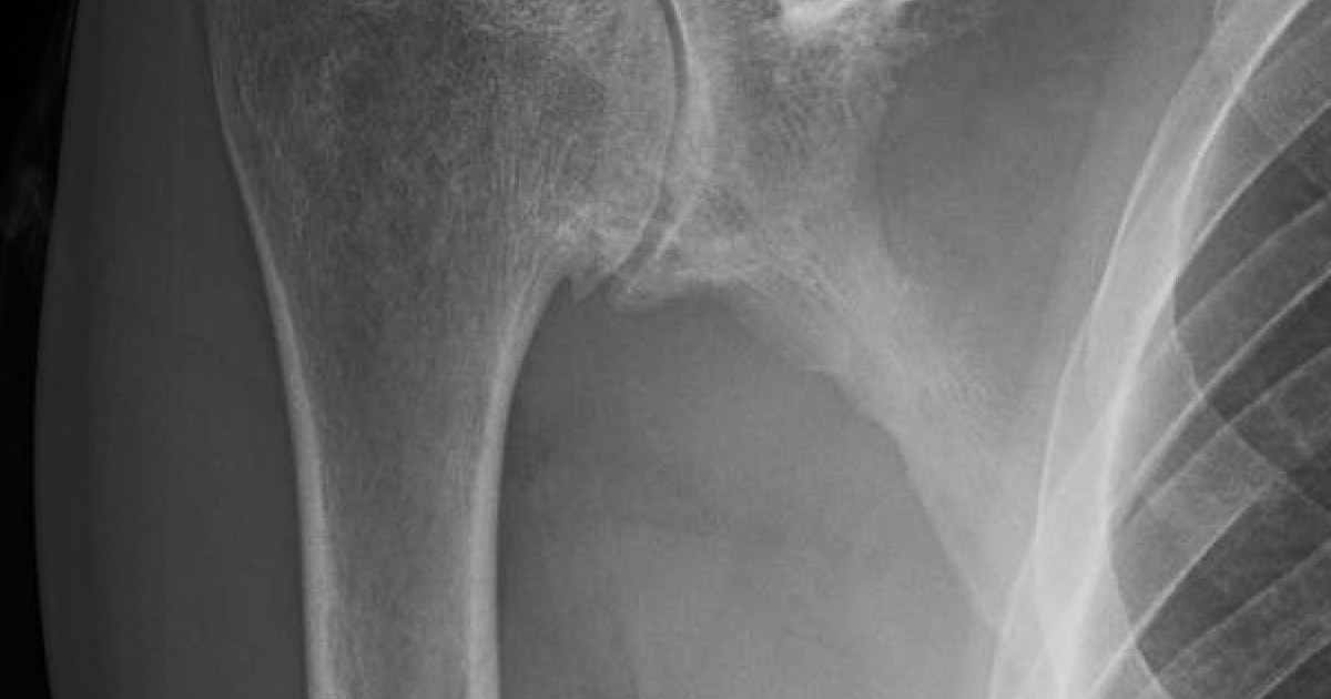 Shoulder and Elbow Surgery: Short stems in anatomic total shoulder ...