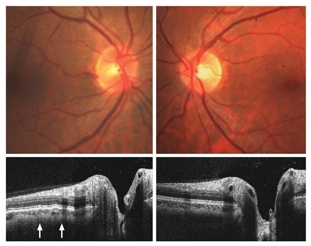 TYWKIWDBI ("Tai-Wiki-Widbee"): Astronauts developing visual impairment