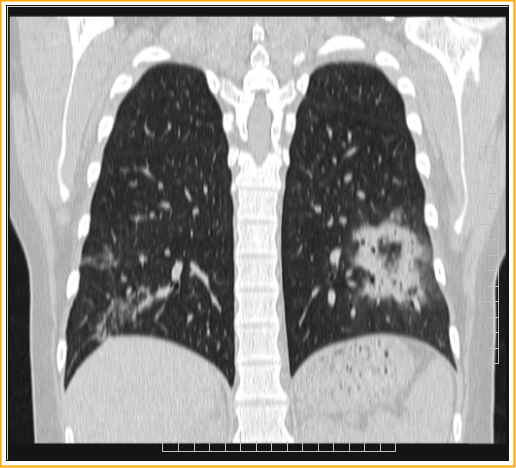 Reverse Halo Sign-CT - Sumer's Radiology Blog