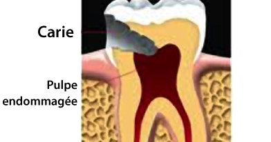 The Best Dentist: Qu’est-ce qu’un abcès dentaire?