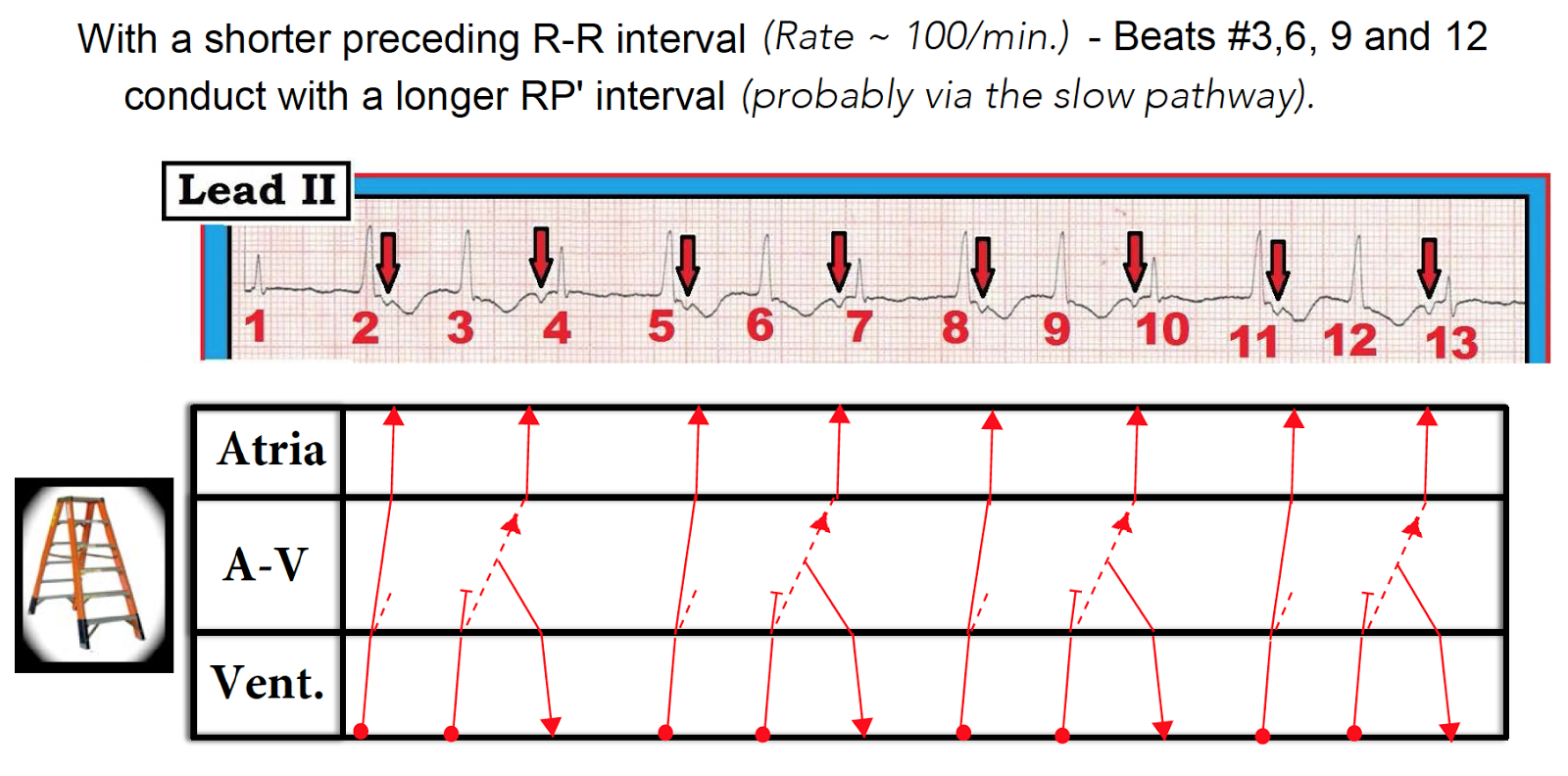 ECG Interpretation: ECG Blog #107 — Ventricular Echo?