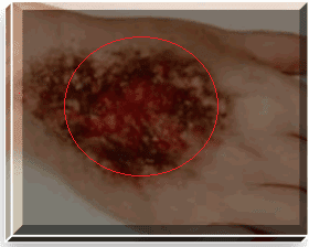 Jenis-jenis Luka (Vulnus) Berdasarkan Penyebabnya