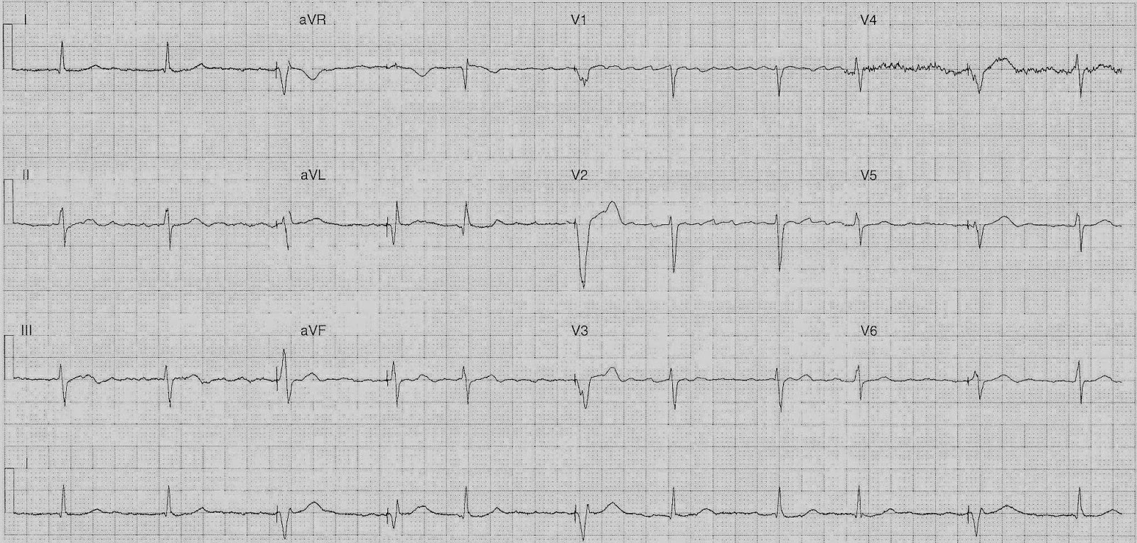 ECG of the Week: ECG of the Week - 4th August 2014