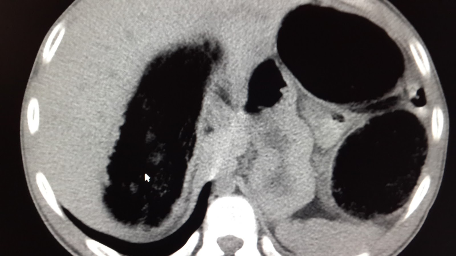 EL RINCÓN DE LA MEDICINA INTERNA: MEGACOLON EN VARÓN DE 17 AÑOS