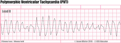 ECG Educator Blog : Polymorphic Ventricular Tachycardia (PVT)