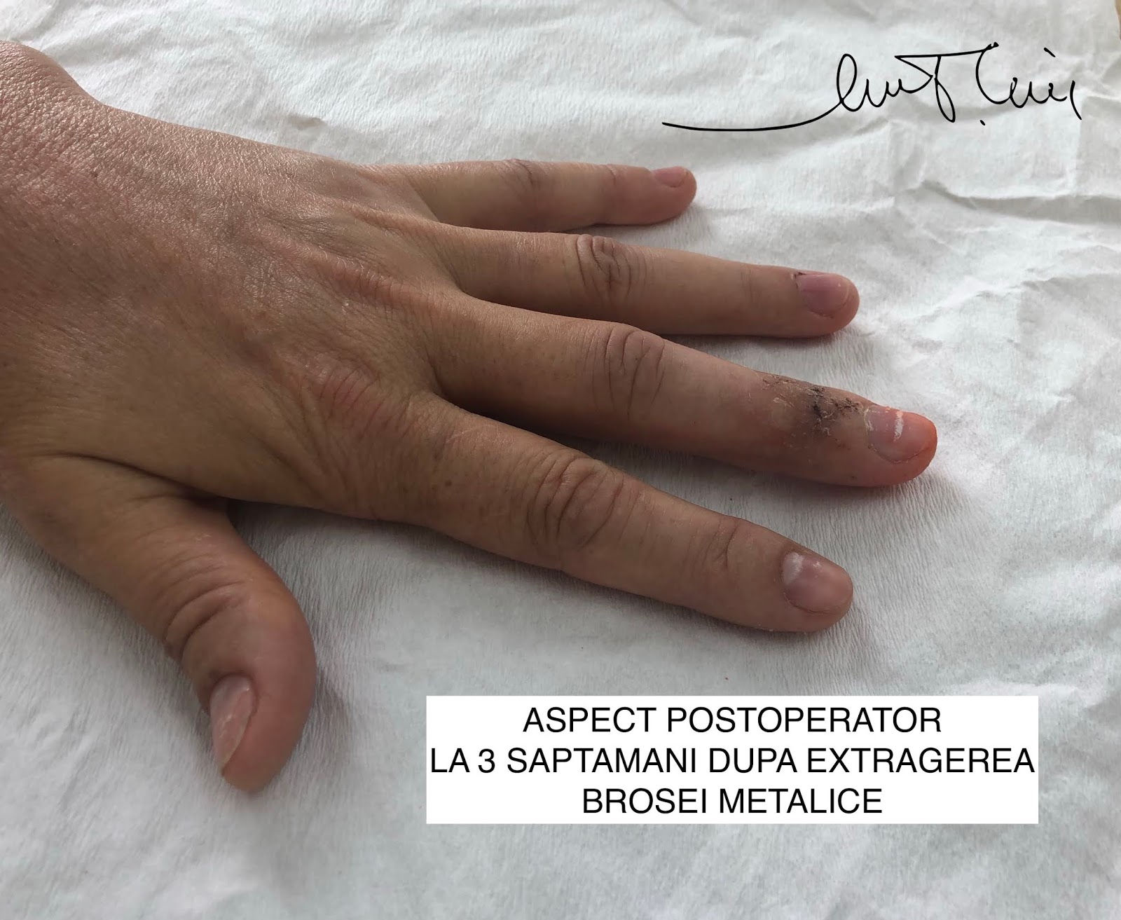 RUPTURA DE TENDON EXTENSOR - DEGET " IN CIOCAN"