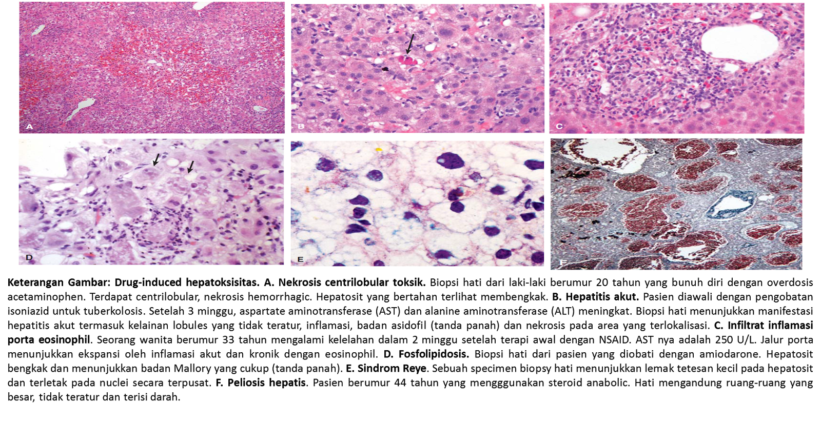 Kehidupan dan Dunia-ku: because it is HEPATITIS