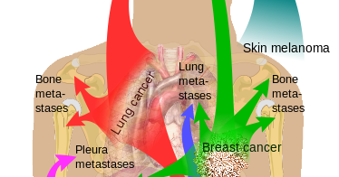 MedicoNotebook: Main sites of metastases for common cancer types