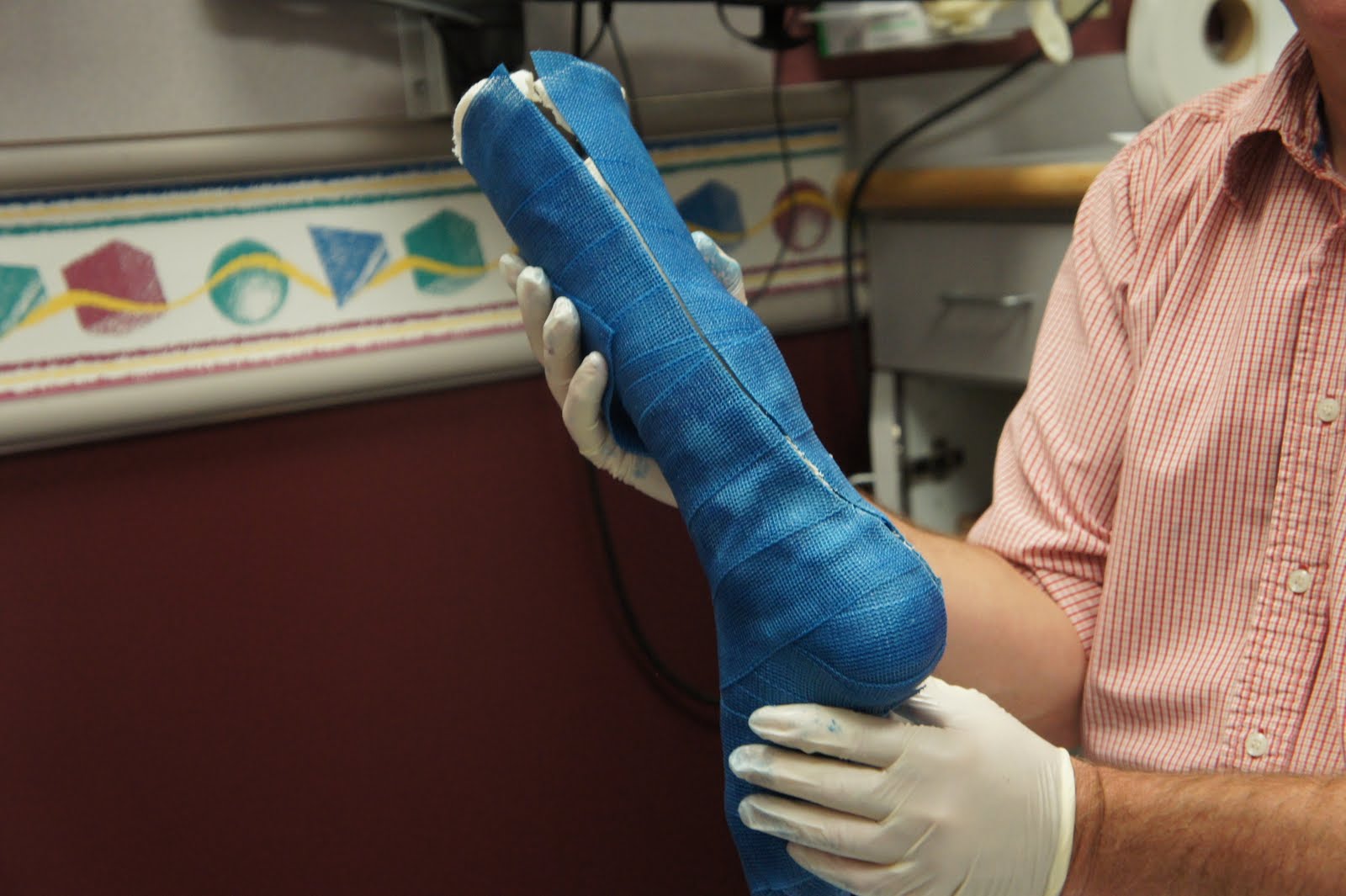 Steven Battles Cancer: Getting started with a prosthetic