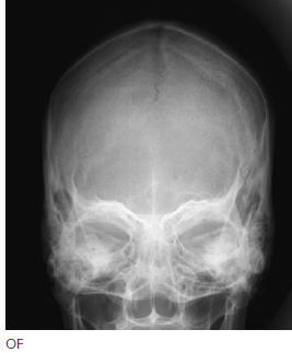 Medical Imaging Technology: Skull Radiography- Lateral and PA views
