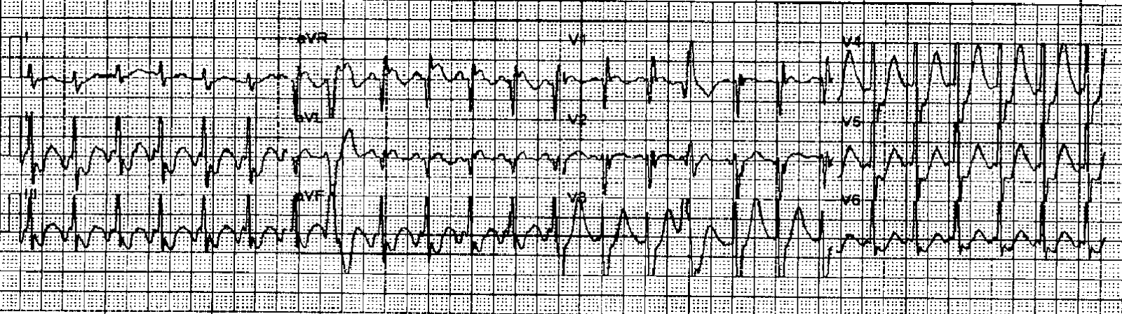 Dr. Smith's ECG Blog: August 2017