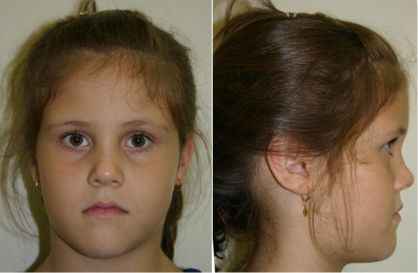 Clinica Denari - O Blog: TRATAMENTO DE PROGNATISMO