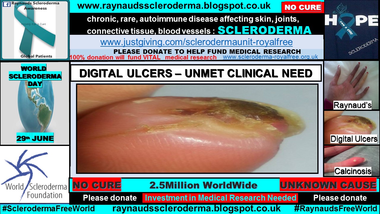 Raynauds Scleroderma Global Patients: DAY 9: Raynuad's Digital Ulcer ...