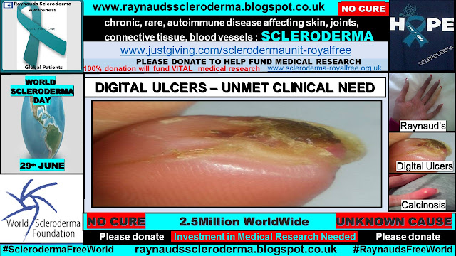Raynauds Scleroderma Global Patients: DAY 9: Raynuad's Digital Ulcer ...