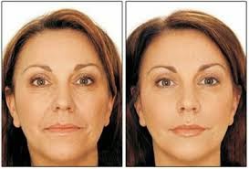 Medical Treatment Pictures-for Better Understanding: Strabismus Surgery ...