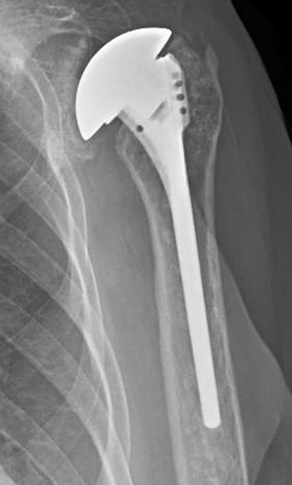 UW Shoulder and Elbow Academy: Shoulder joint replacement - special ...