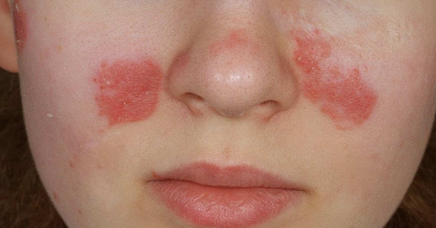 DERMATOLOGIE, VENEROLOGIE SI COSMETICA.: LUPUSUL ERITEMATOS