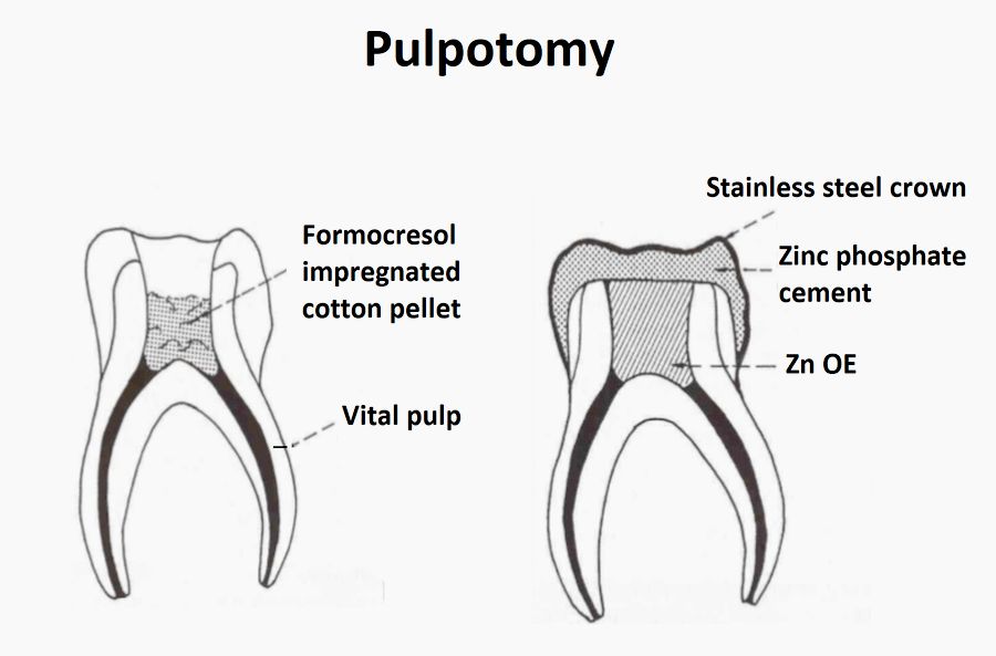 Pulpectomy