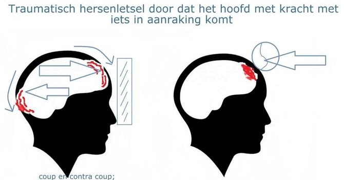 Hoofd trauma. Stomp letsel - Acute Zorg Blog