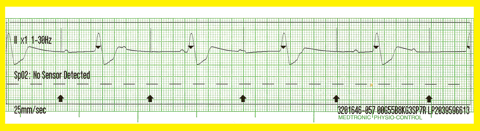 Practice EKG Strips 387