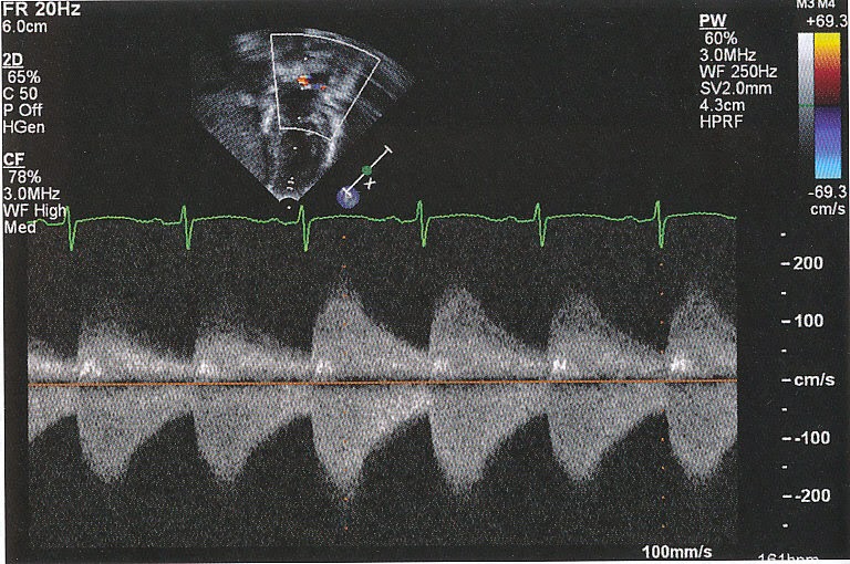 Pedi Cardiology Echo Artifacts pedi-cardiology-echo-artifacts