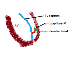 easyhumanatomy: Moderator band / septomarginal trabeculum