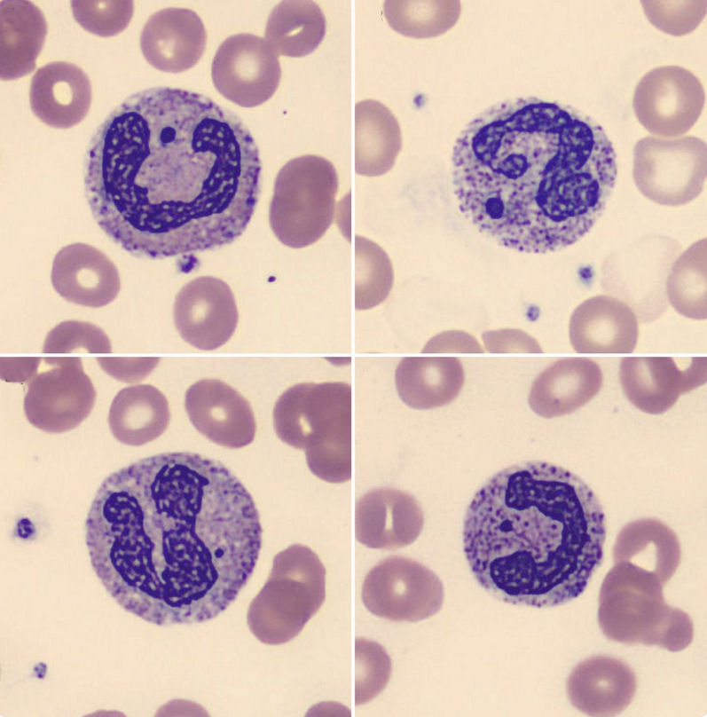 Medical Laboratory and Biomedical Science: Howell-Jolly–like bodies in ...