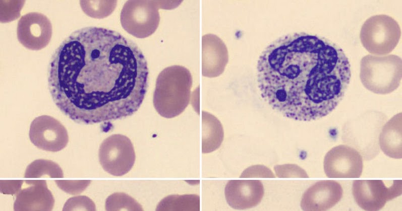 Medical Laboratory and Biomedical Science: Howell-Jolly–like bodies in ...