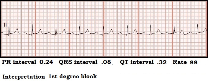 ECG Rhythm Strip Quiz 81: Interval measurements