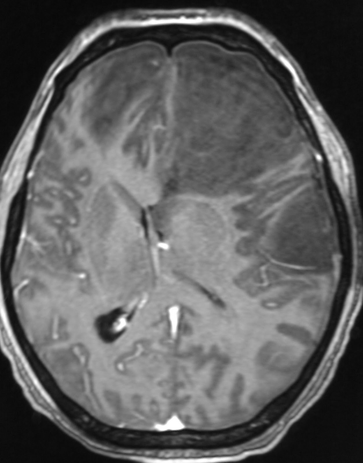 Meningoencephalitis; Cerebromeningitis