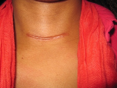 Scarless Endoscopic Thyroidectomy | Malabar Institute Of Medical ...