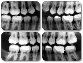 Dentistry and Medicine: Intraoral Radiographic Techniques (Bitewing ...