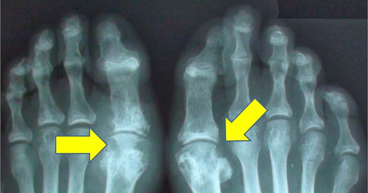 Radiologia & Bio-Imagem ☢: TUMORES ÓSSEOS