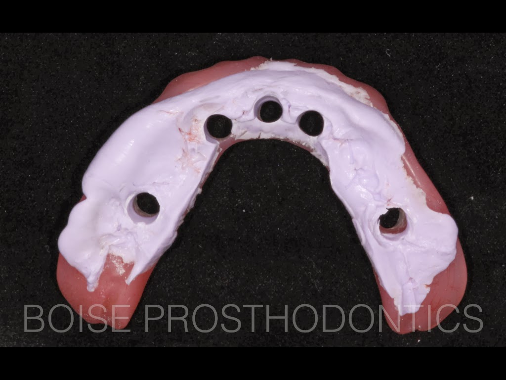 Boise Idaho Prosthodontics: Immediate Load Implant Prosthesis - Hybrid