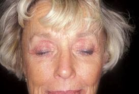 Medical Treatment Pictures-for Better Understanding: Dermatomyositis