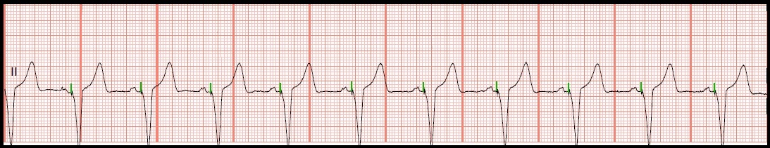 ECG Rhythm Strip Quiz 105