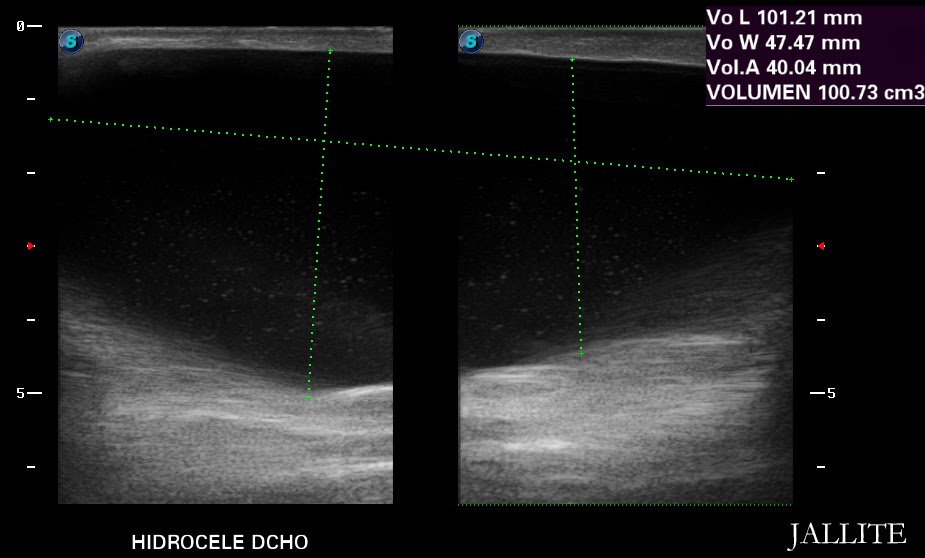 Hidrocele Bilateral y....