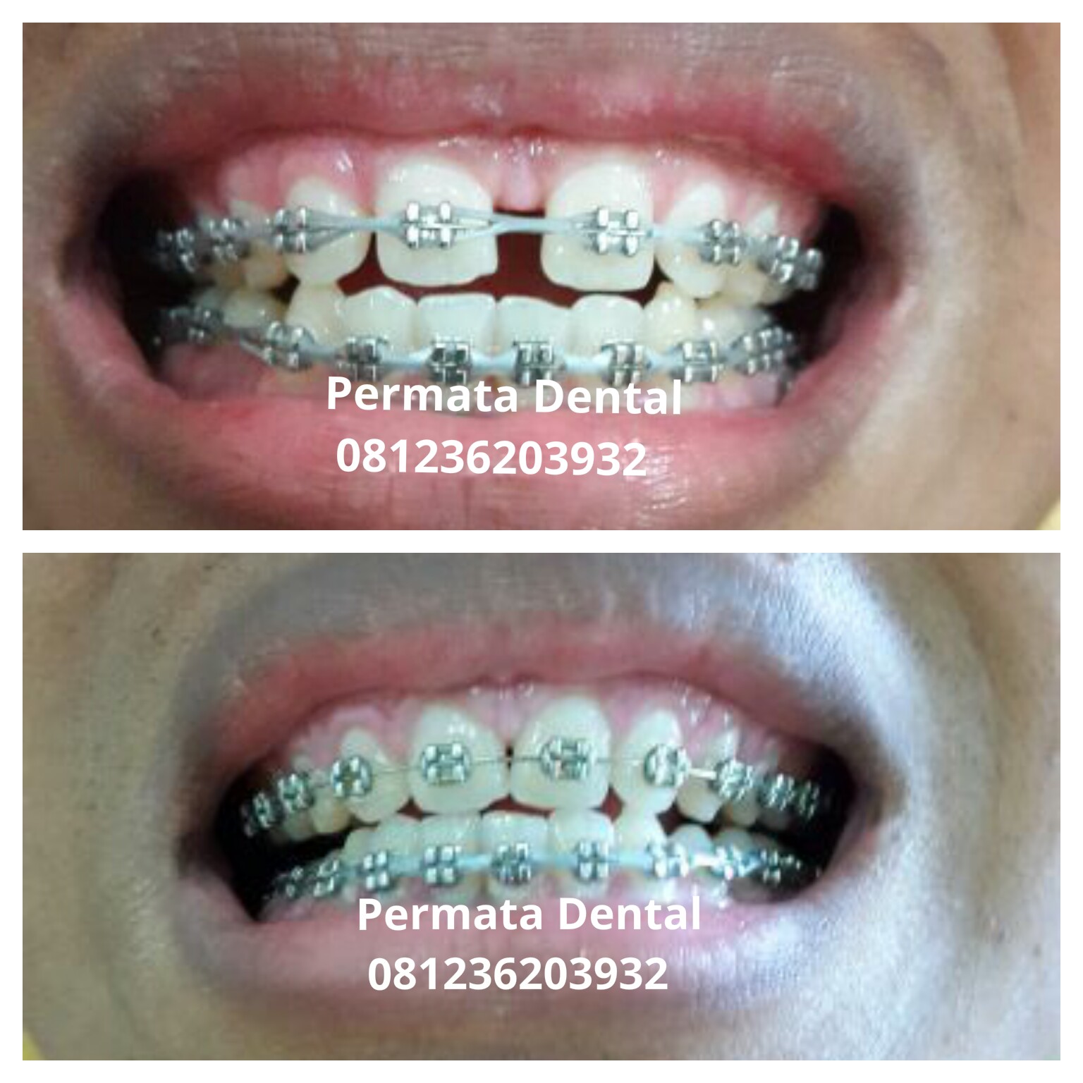 DOKTER GIGI BALI: Behel | Barcket | Kawat Gigi Perawatan