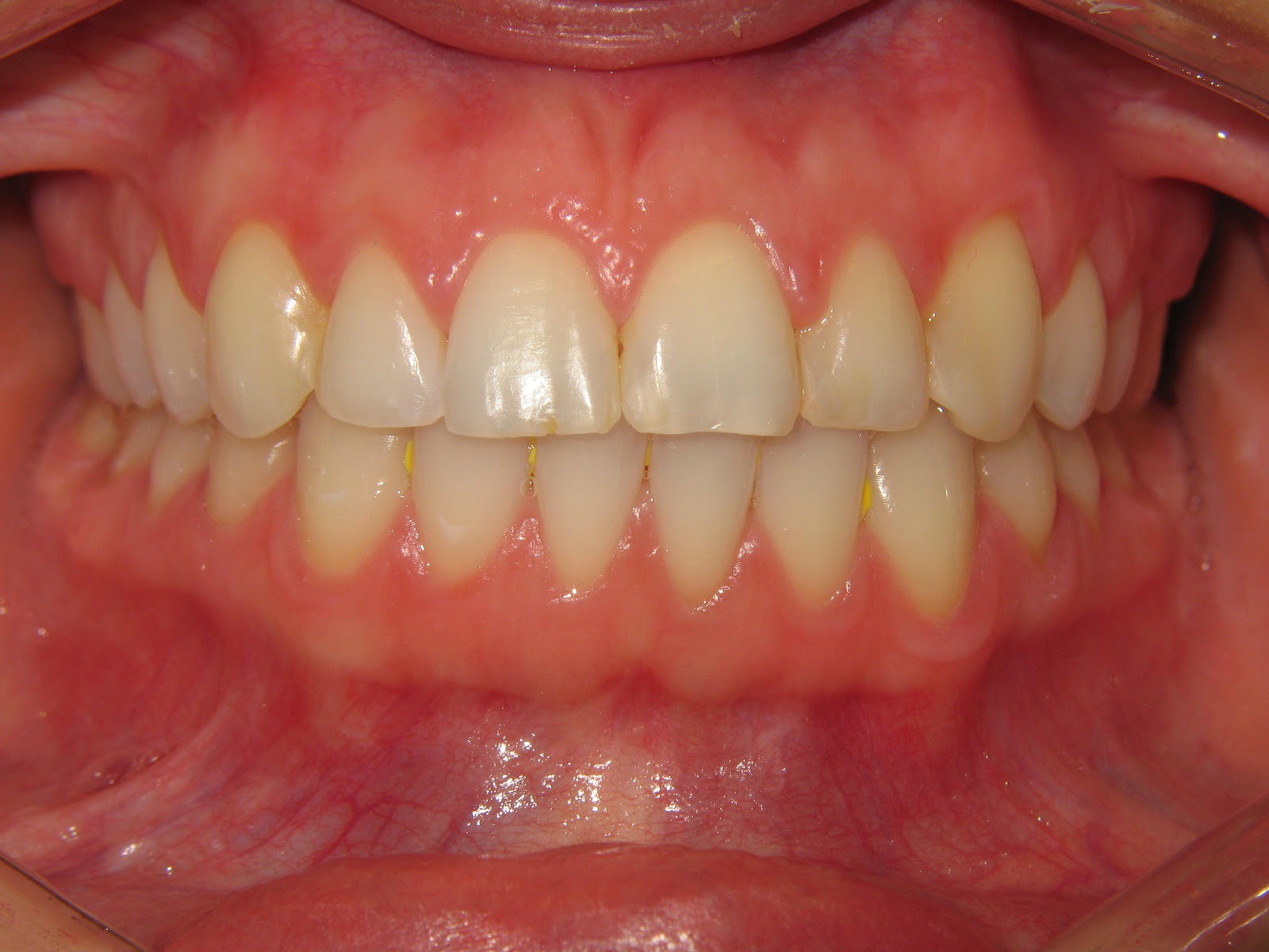 Barry Family Dental Group: Esthetic Tooth Recontouring