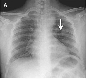 The Feria Journal of Medicine: Paragonimiasis - NEJM