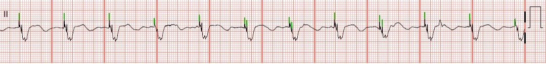 EKG Rhythm Strip Quiz 56: Paced Rhythms